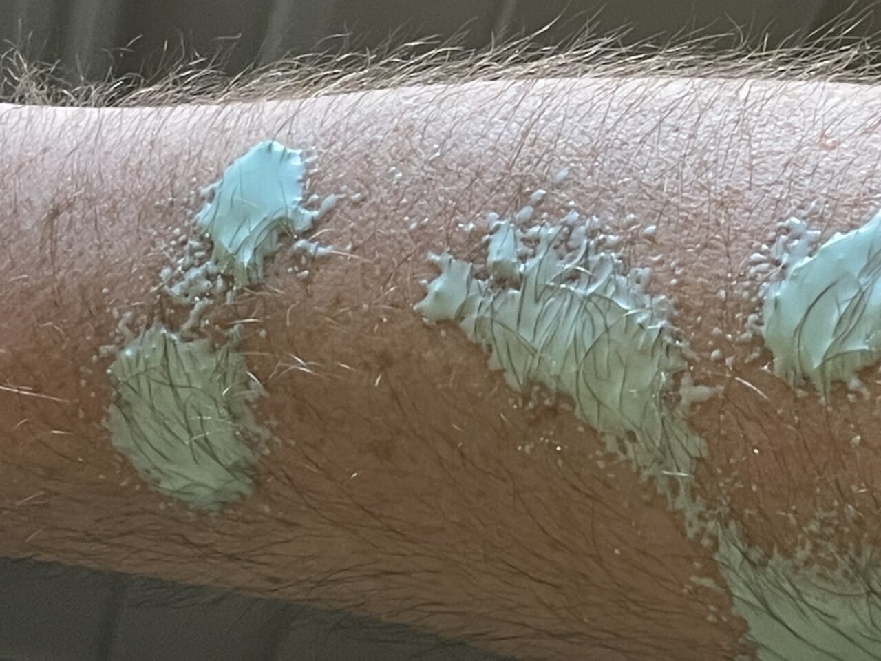 Sunburn - McCann Training Solutions